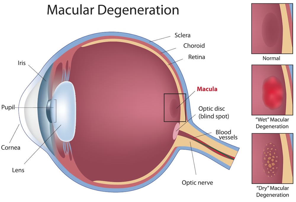 Glaucoma Retinitis Macular Degeneration Acupuncture Treatment glaucoma-retinitis-macular-degeneration-acupuncture-treatment